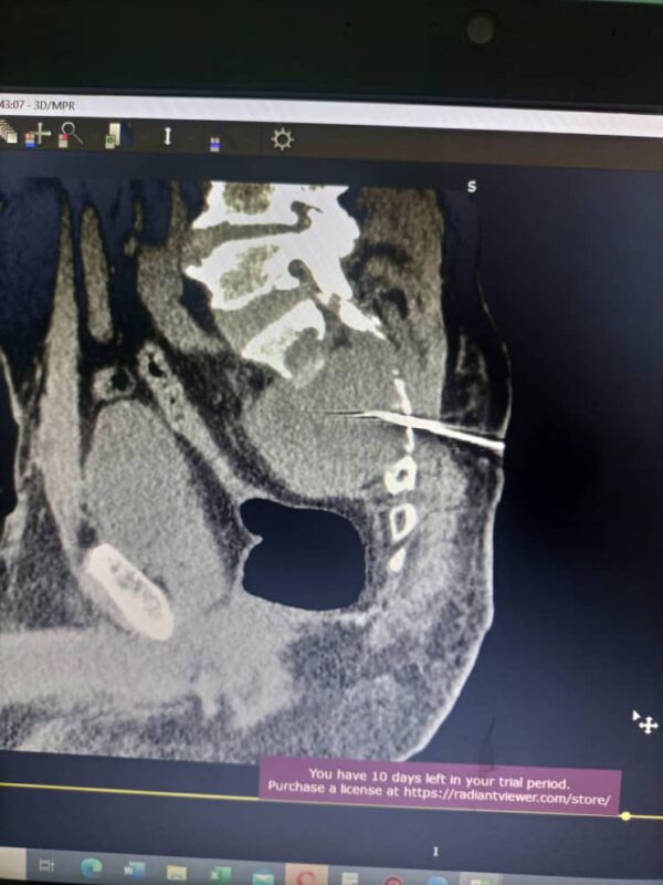 Biopsie scanno-guidée - Cliniques Universitaires de Kinshasa